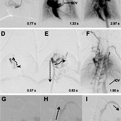 Collateral ante- and retrograde flow pattern.