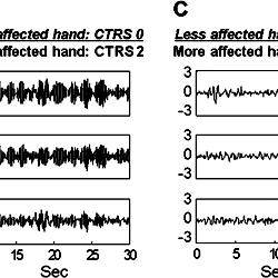 Tremor signals by accelerometer in the less affected hand across ...