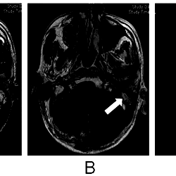 Mastoiditis Mri