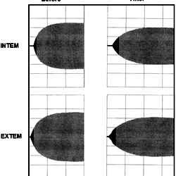 INTEM and EXTEM analyses before and after therapeutic plasma exchange ...