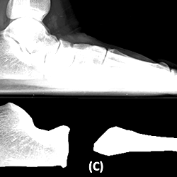 Lateral radiographic image of a participant.