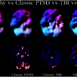 Brain SPECT Images of Healthy, PTSD, TBI and PTSD Co-morbid with TBI ...