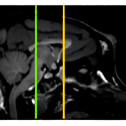 An example of how anterior cingulate cortex and posterior cingulate ...