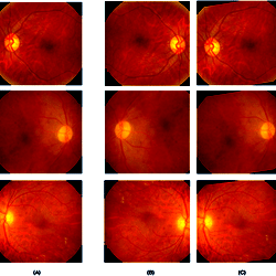 Reprenstative fundus images depicting our augmentation techniques.