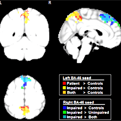 Brain regions showing significant differences in seed-based functional ...