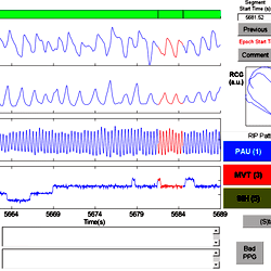 Representative example of Asynchronous-Breathing (ASB).