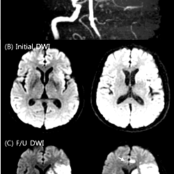 Example of a high percent insular ribbon infarction (PIRI) score.