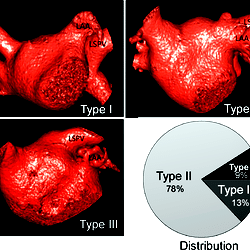 Three-dimensional images showed the three types of the left atrial ...