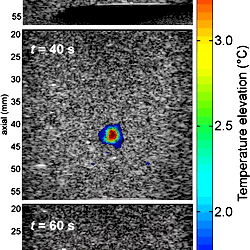 Temperature map and ultrasound imaging.