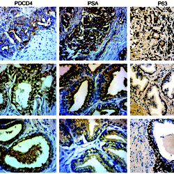 PDCD4 and PSA expression in prostate cancer, prostatic intraepithelial ...