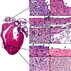 Description of Lyme carditis pathology.