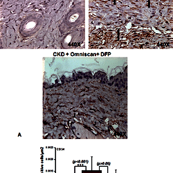Expression of CD34+ cells in NSF skin as shown by immunohistochemistry.