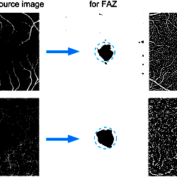 OCTA Image processing for FAZ and VD analyses.