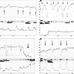 Examples of different FHR deceleration subtypes on CTG.