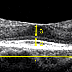 Diagrams of quantitative SD-OCT parameters.