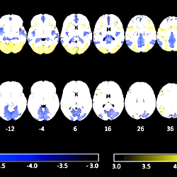 Brain activation maps during task completion.