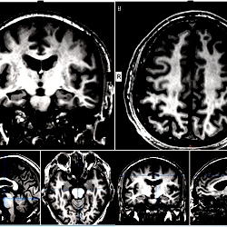 Illustrating the moderate atrophy of MTA and PA scores.