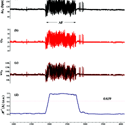 Example for the application of this method for detecting AF.