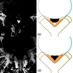 Schizas classification.