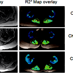 illustrates anatomic MRI and R2* maps from a representative subject ...