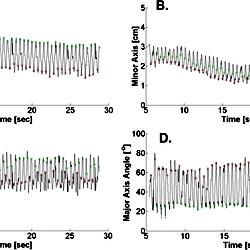 Changes in LV geometry before and during VCO.