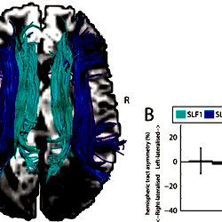 (A) Tractographic rendering of SLF branches in one subject obtained ...