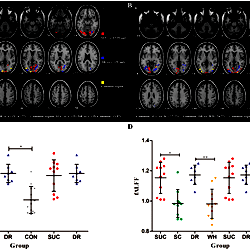 Spatial overlapping maps and scatter plots showing fALFF values of overlaps.