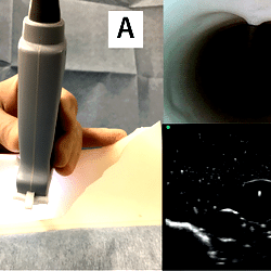A novel shallow angle of approach needle guide.