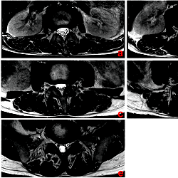 Transverse MR images at different disc level.