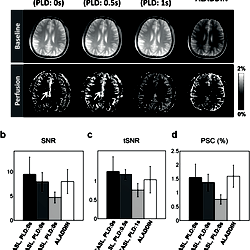 Comparison of ALADDIN and pCASL perfusion imaging.
