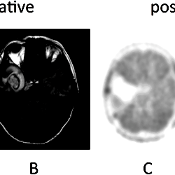 Example of a complete resection.