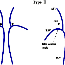 Diagrammatic representation of TSV types I and II containing venous ...