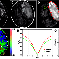 A 27-year-old female with an acute cardioembolic infarction fifteen ...