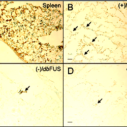 Anti-CD56-HRP plus Prussian Blue staining of spleen and tumor regions ...