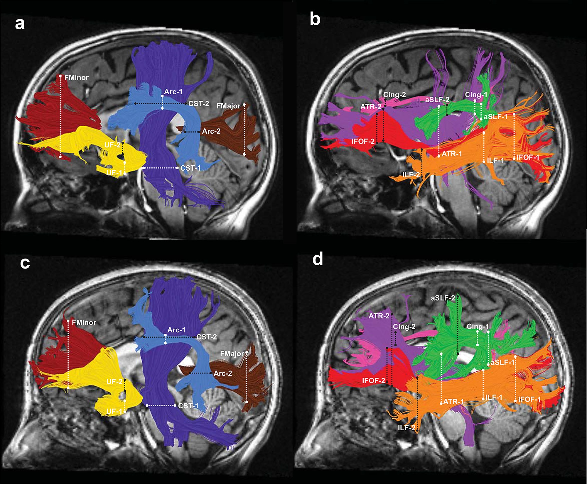Cerebral White Matter Tracts