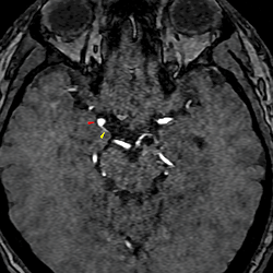 Illustrative image of an infundibulum of the PCoA.