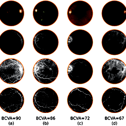 Example images across the range of best corrected visual acuity (BCVA ...