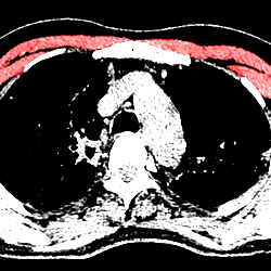 Measurement of pectoralis muscle area on chest CT.
