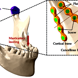 Unilateral subcondylar fracture model of the mandible.