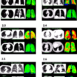 The High Resolution Computerized Scan (HRCT) monitoring before and ...