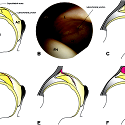 Schematic representation of labral tear grades in patients with hip ...