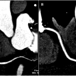 CTCA images of right coronary artery.