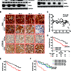 A negative correlation between Aldob and p-Akt expression in human HCC ...