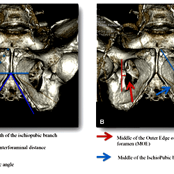 A & B: Bony measurements and bony landmarks on 3D angiotomodensitometry ...