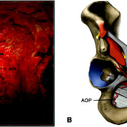 A. Obturator arteries reconstructions by angiotomodensitometry. The ...