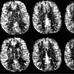 Representative CBF maps of one study participant.