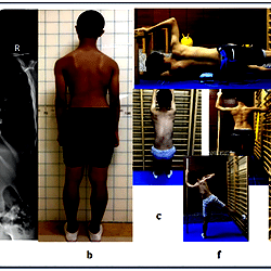 Exercises demonstration for major left lumbar curves.
