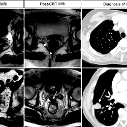 Representative images of a pre-CRT MRI (left column), post-CRT MRI ...