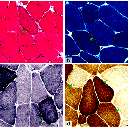 Muscle pathology for patient 3.