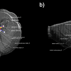 Views of functional networks with the bilateral RSCs shown in the three ...